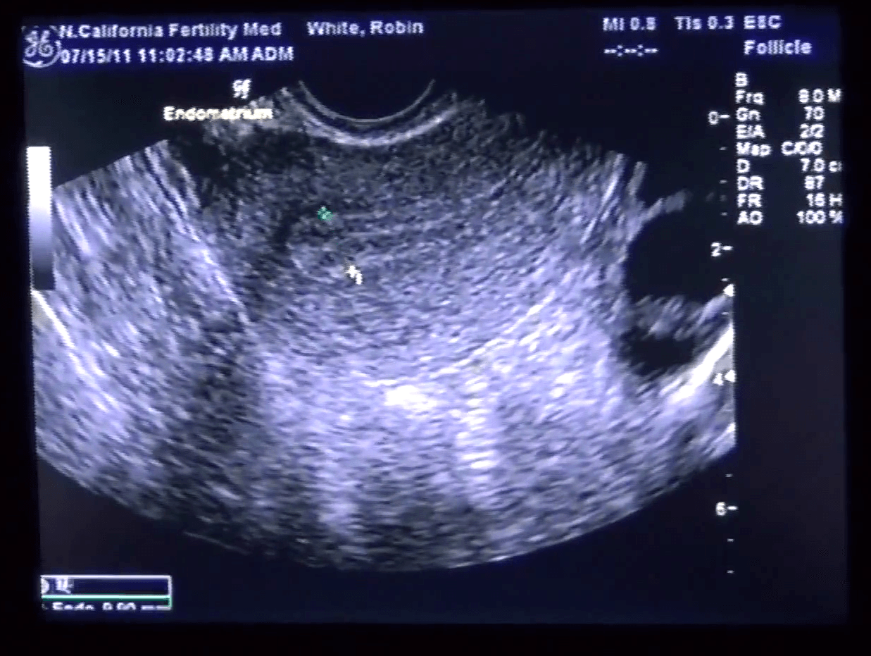 Le monitorage des ovaires