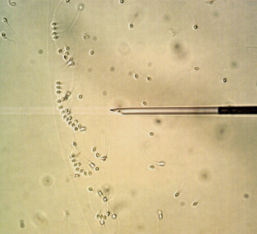 PICSI (Sélection des spermatozoides)